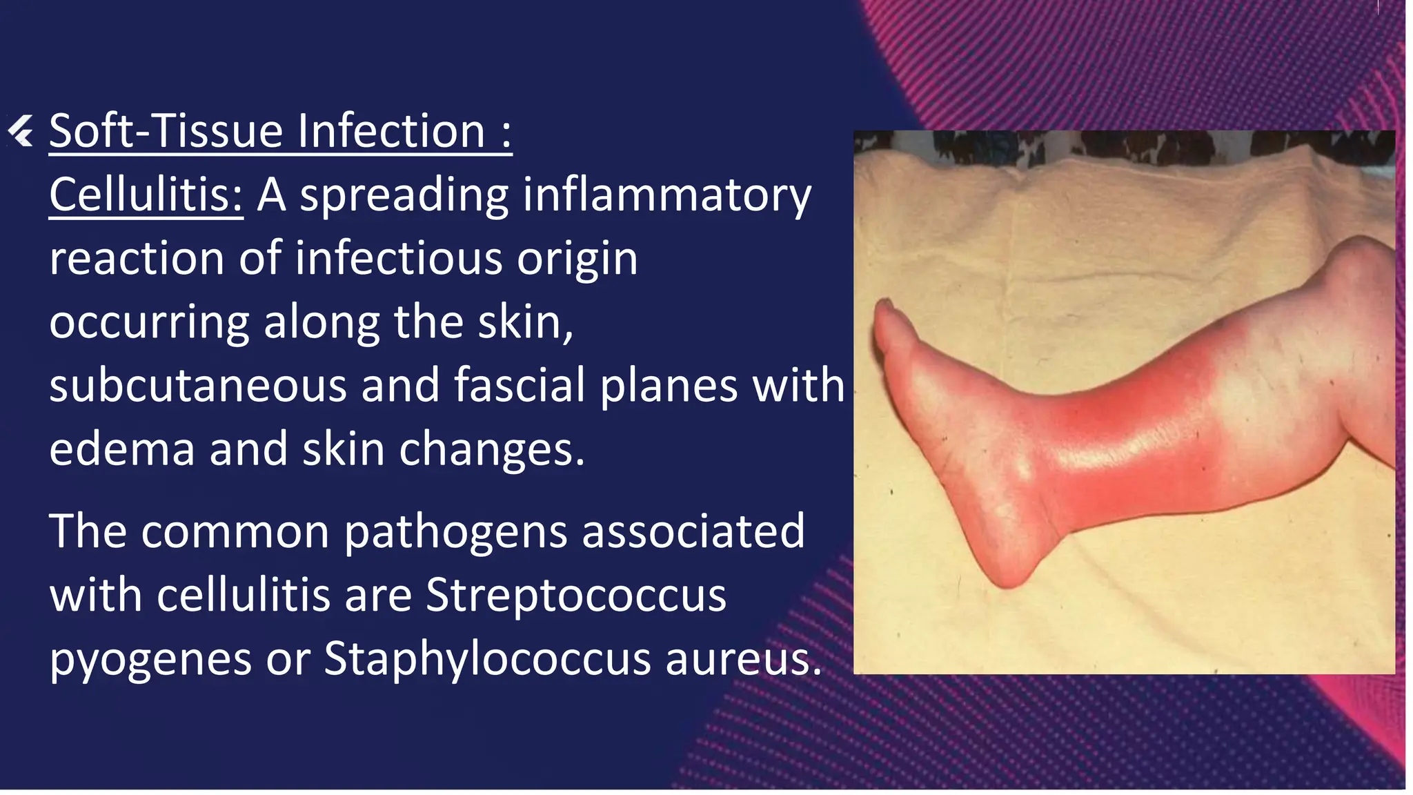 Musculoskeletal infection by capt alauddin.pptx