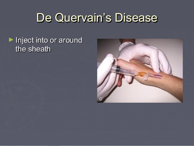 Musculoskeletal injections