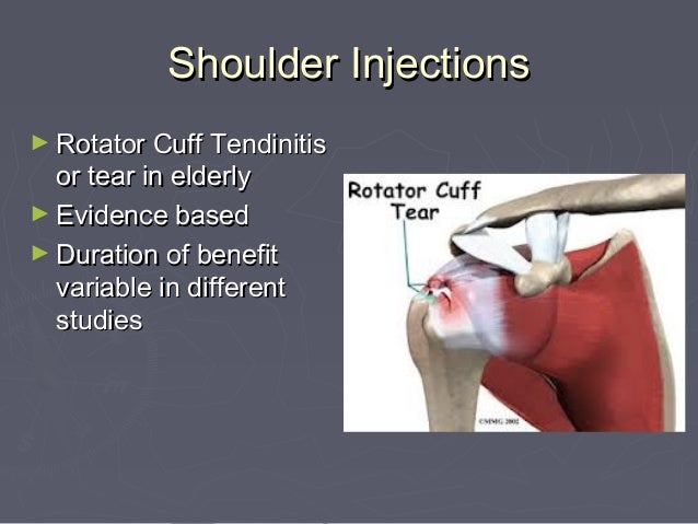 Musculoskeletal injections