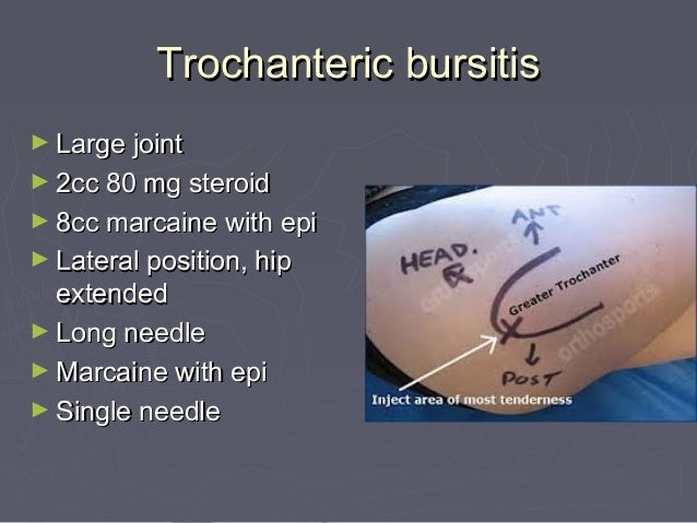 Trochanteric Bursitis Injection