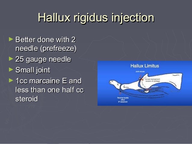 Musculoskeletal injections