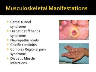 Musculoskeletal manifestations of diabetes mellitus | PPT