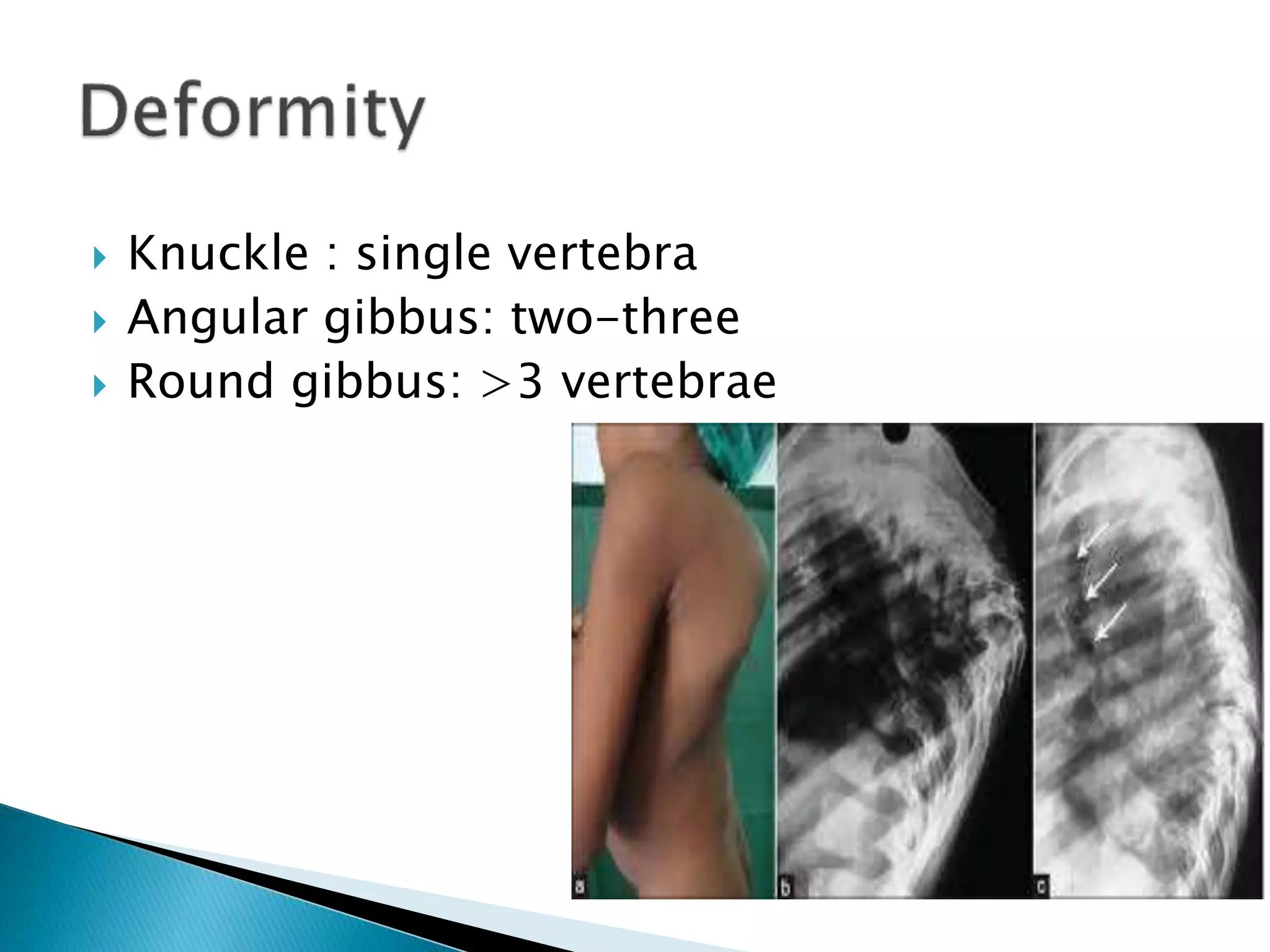 Musculoskeletal Tuberculosis overview | PPTX