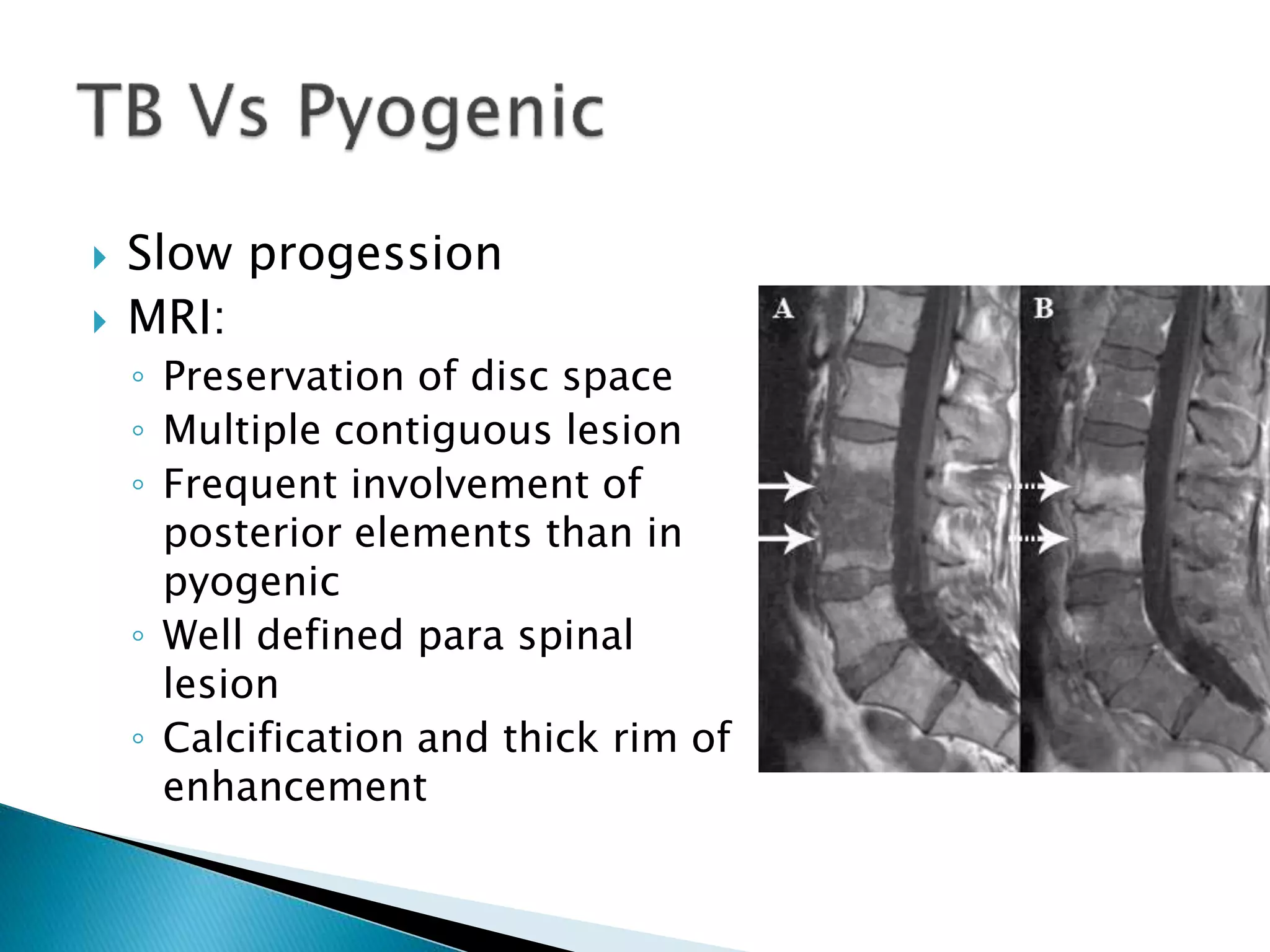 Musculoskeletal Tuberculosis overview | PPTX