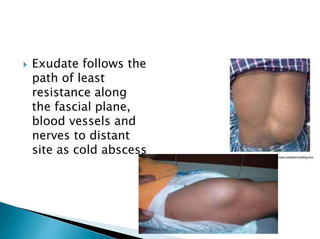 Musculoskeletal Tuberculosis overview | PPTX | Bone and Joint ...