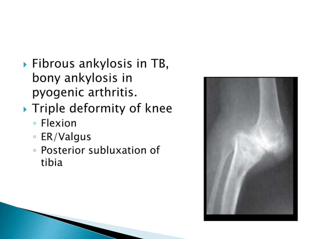 Musculoskeletal Tuberculosis overview | PPTX | Bone and Joint ...