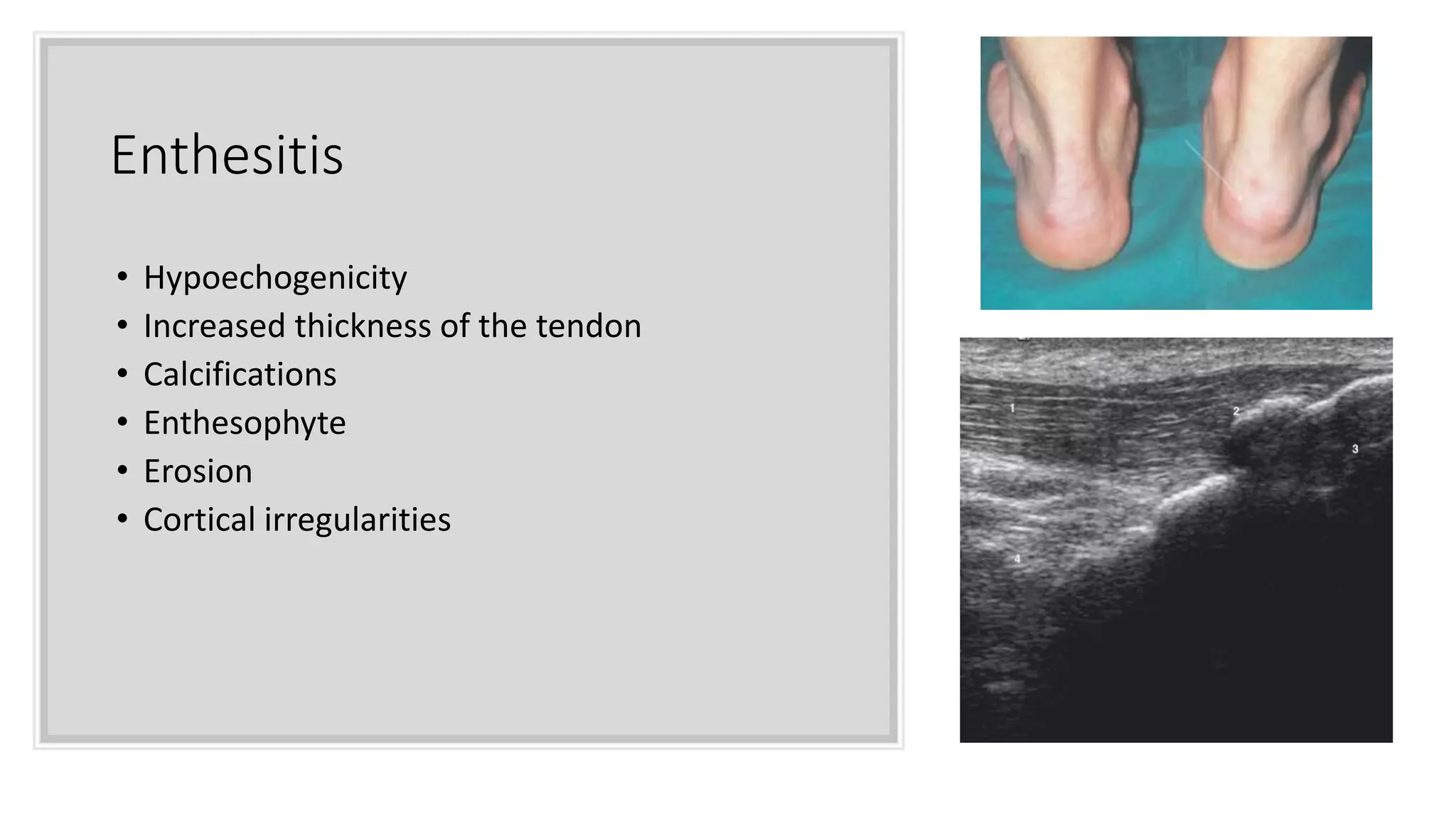 Musculoskeletal ultrasound in nephrology | PPTX