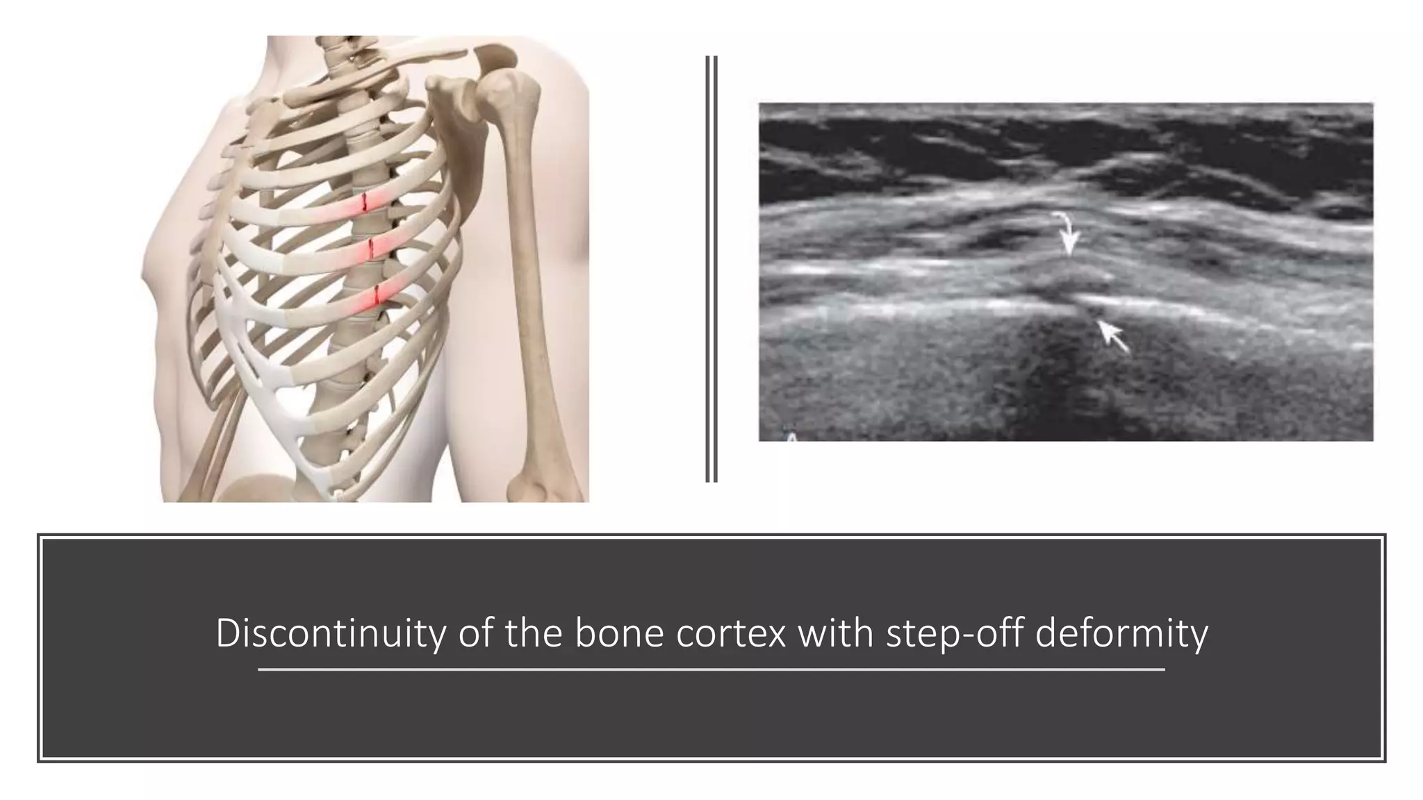 Musculoskeletal ultrasound in nephrology | PPTX