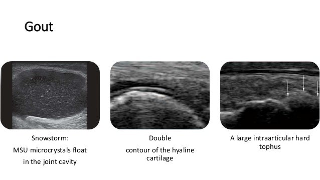 Musculoskeletal ultrasound in nephrology