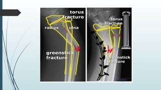 MUSCULOSKELTAL TRAUMA IMAGING (1).pptx