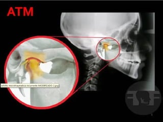 Musculos, ligamentos y atm | PPT
