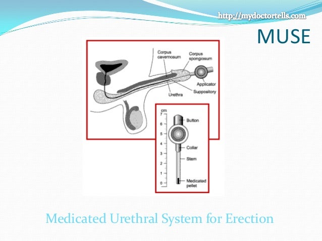 M.U.S.E.Treatment Erectile Dysfunction