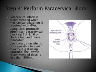 Manual vacuum aspiration | PPTX