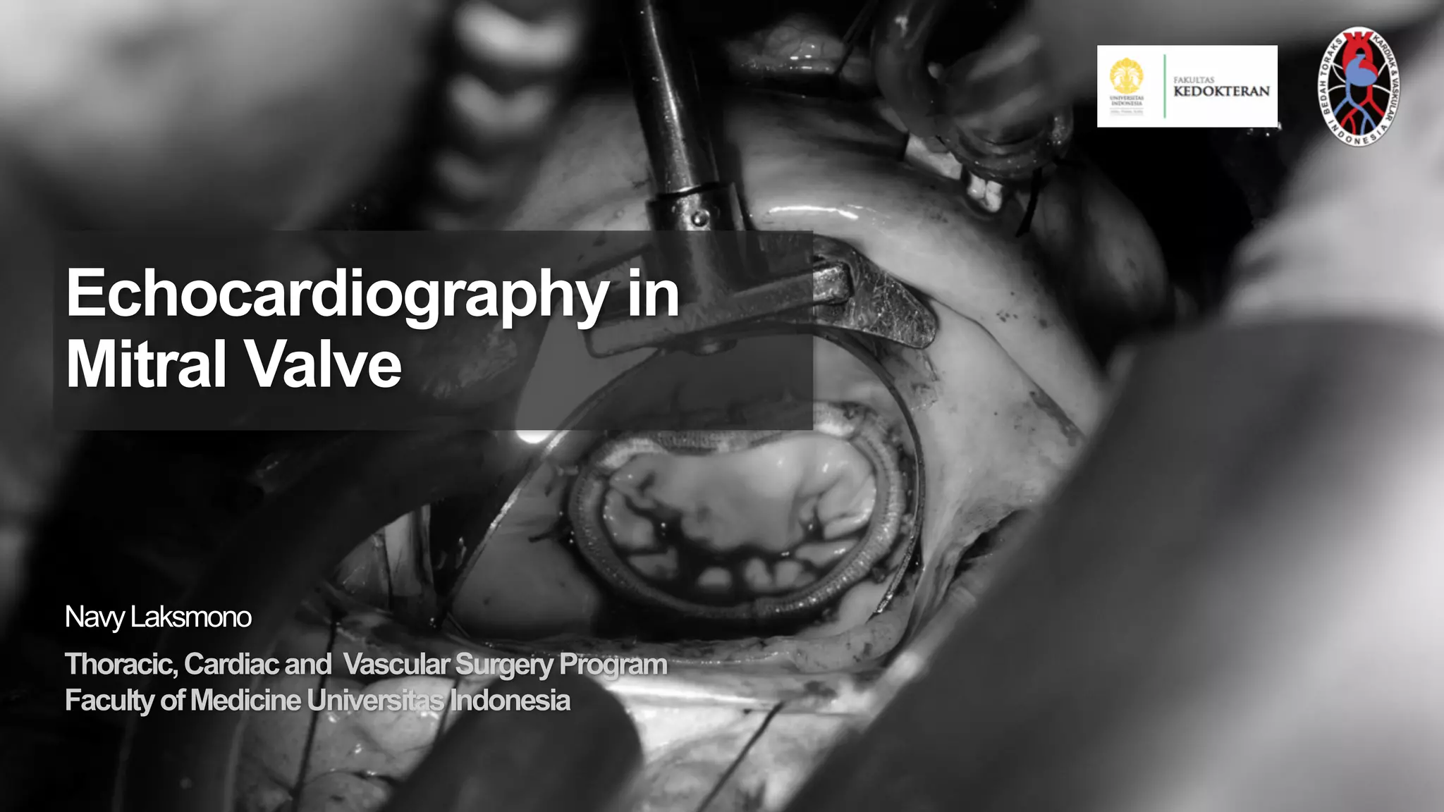 Echocardiography of Mitral Valve : Surgeons perspective | PDF
