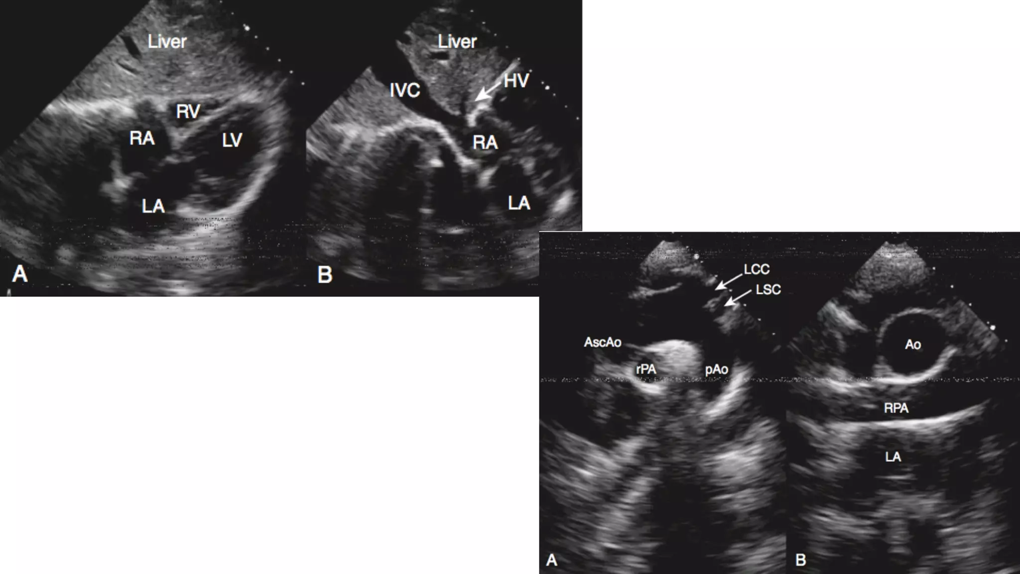 Echocardiography of Mitral Valve : Surgeons perspective | PDF