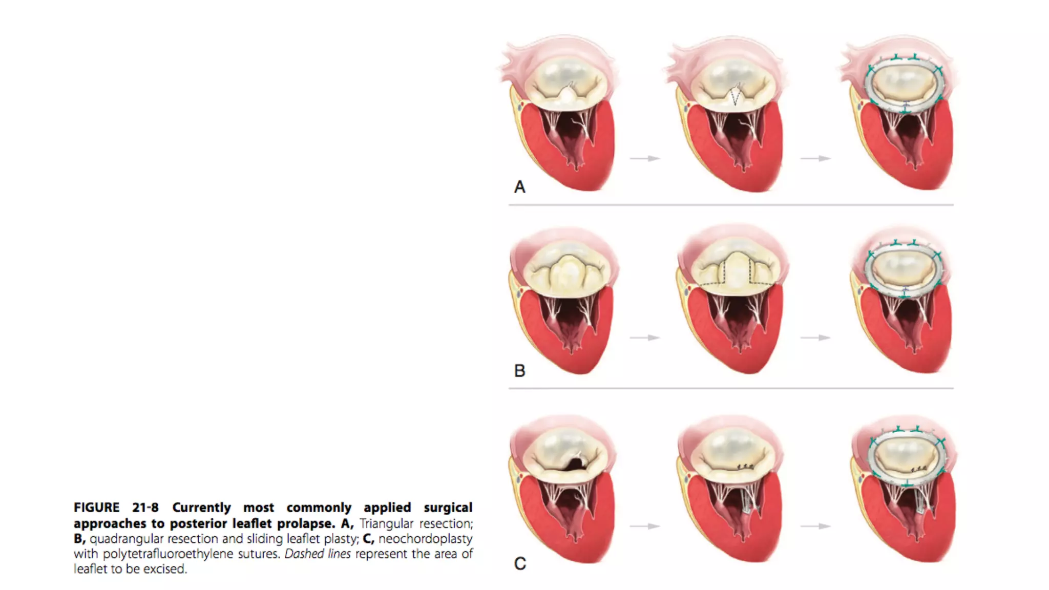 Echocardiography of Mitral Valve : Surgeons perspective | PDF