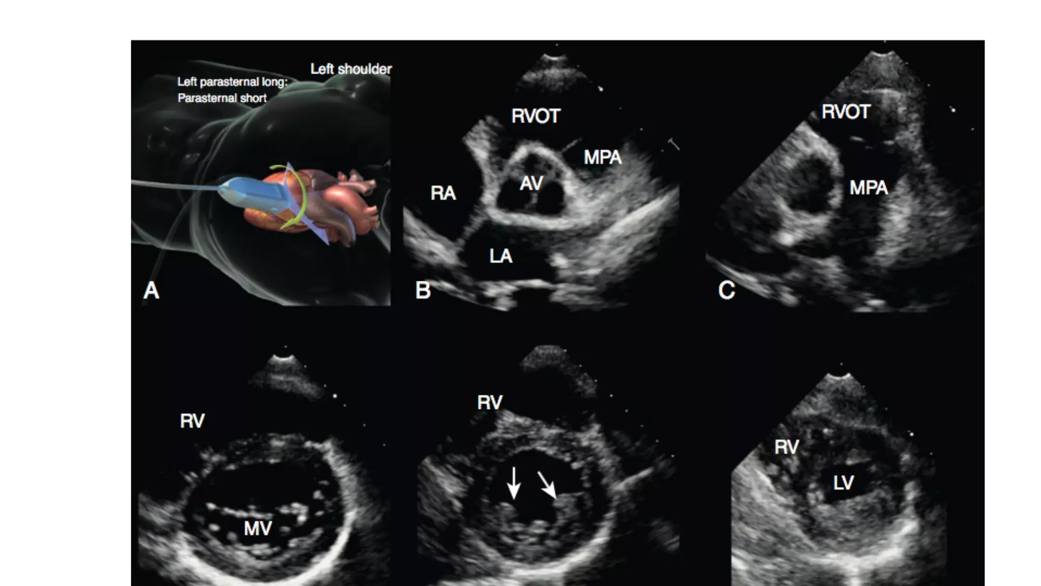 Echocardiography of Mitral Valve : Surgeons perspective | PDF