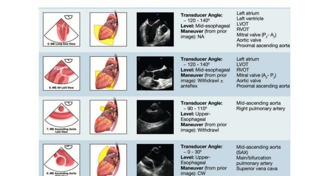 Echocardiography of Mitral Valve : Surgeons perspective | PPT