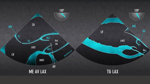 Echocardiography of Mitral Valve : Surgeons perspective | PPT | Free ...