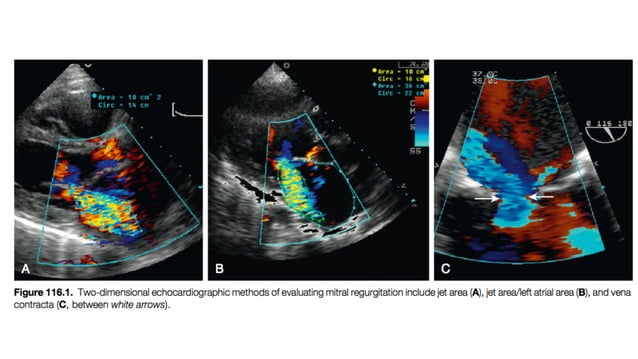 Echocardiography of Mitral Valve : Surgeons perspective | PPT