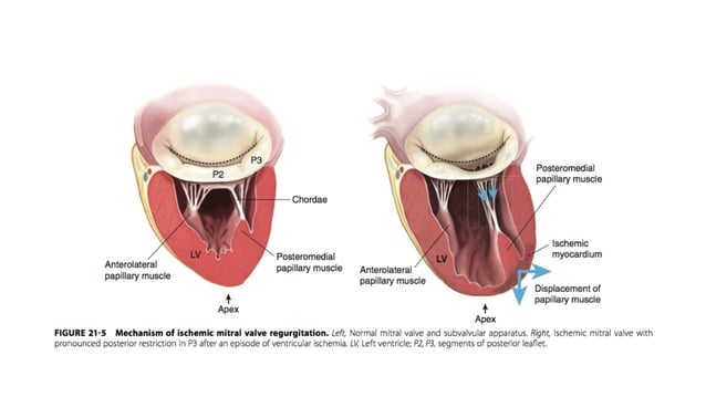Echocardiography of Mitral Valve : Surgeons perspective | PPT
