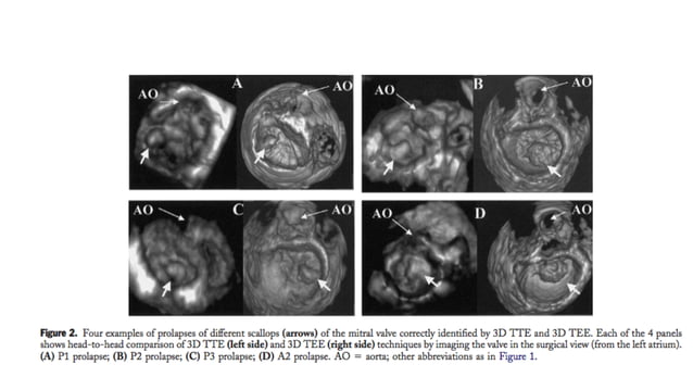 Echocardiography of Mitral Valve : Surgeons perspective | PPT | Free ...