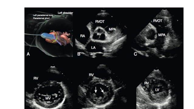 Echocardiography of Mitral Valve : Surgeons perspective | PPT | Free ...