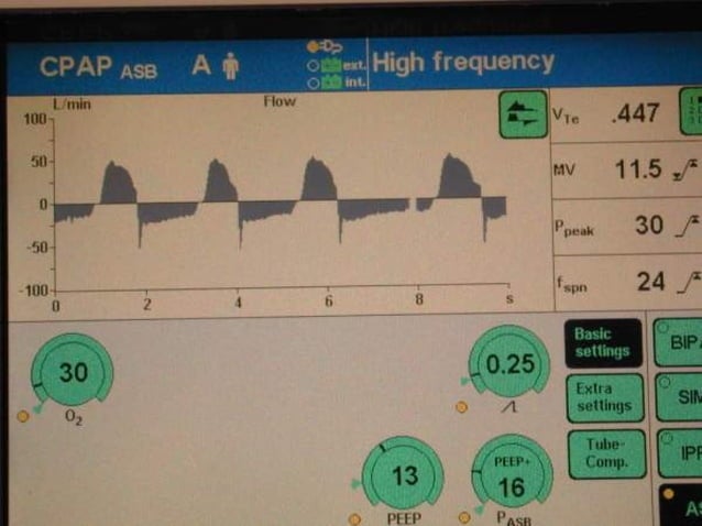 Mechanical ventilation in air flow obstruction | PPT