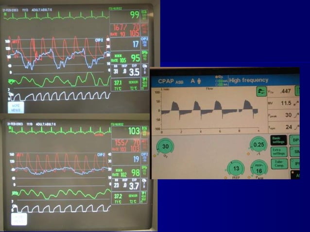 Mechanical ventilation in air flow obstruction | PPT