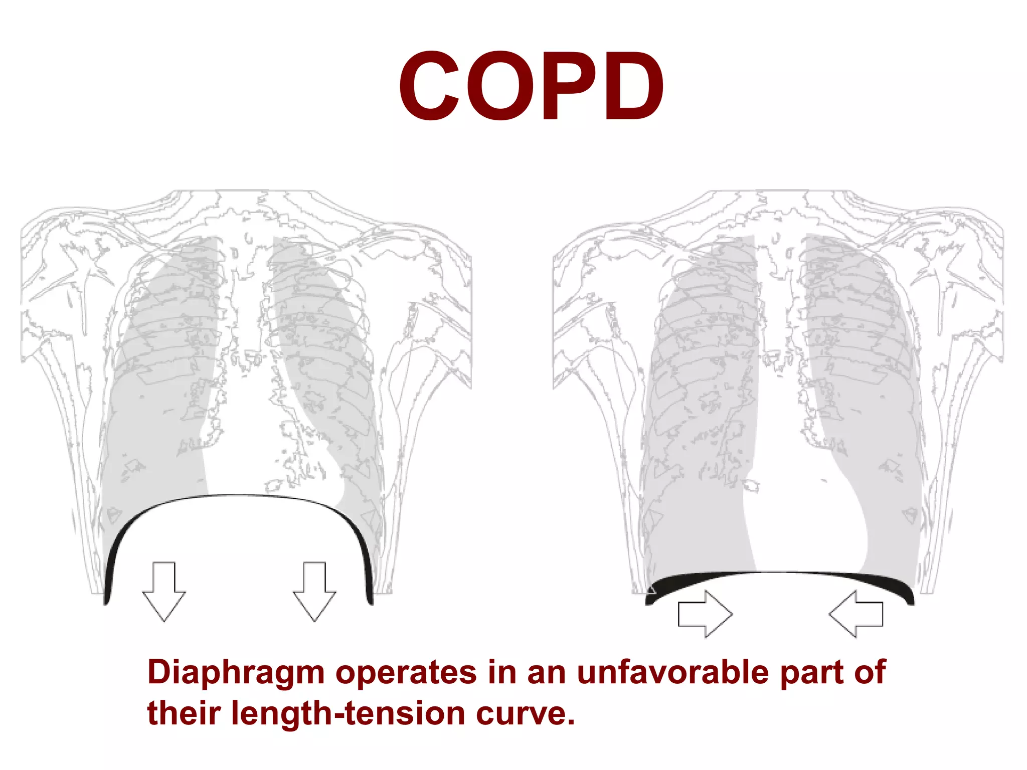 Mechanical Ventilation in COPD Venti Cairo | PDF