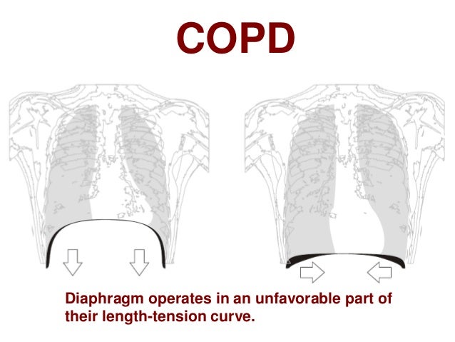 Mechanical Ventilation in COPD Venti Cairo