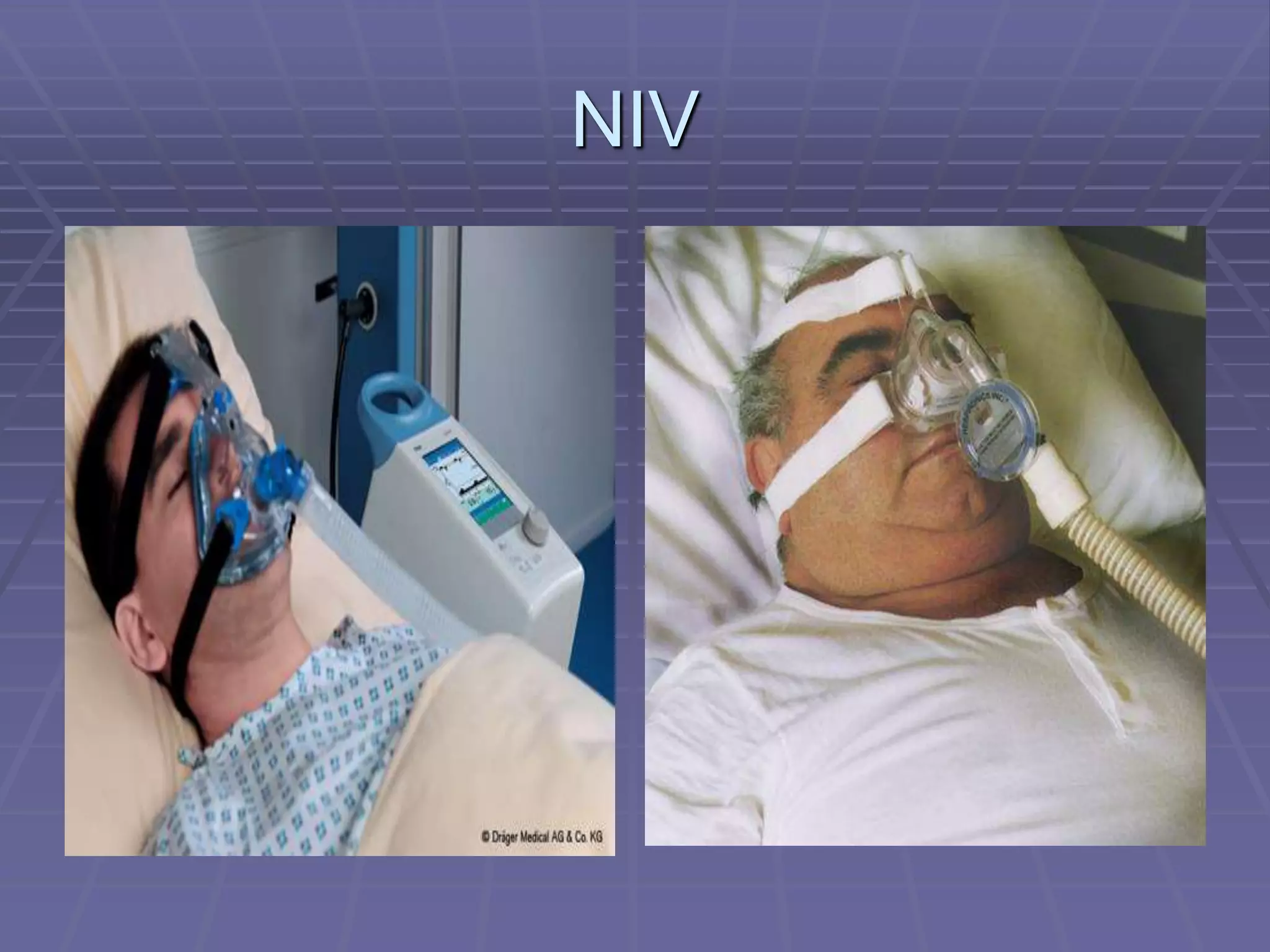 Mechanical Ventilator | PPT