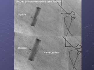 Mv perivalvular leak | PPT