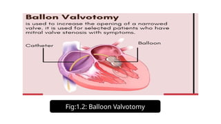 Diagnostic Assessments for Mitral Valve Stenosis Common diagnostic ...