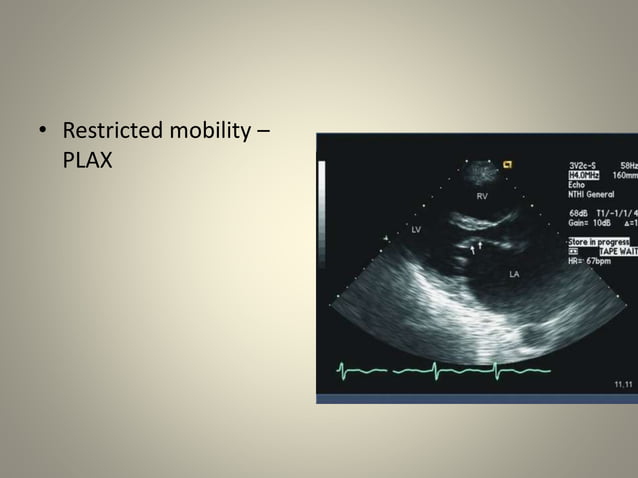 Mitral valve scoring before BMV | PPTX | Heart and Cardiovascular ...