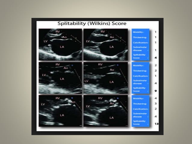 Mitral valve scoring before BMV | PPTX | Heart and Cardiovascular ...