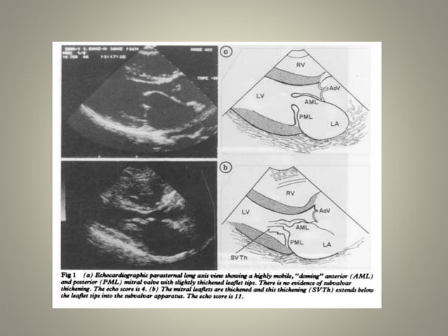 Mitral valve scoring before BMV | PPTX | Heart and Cardiovascular ...
