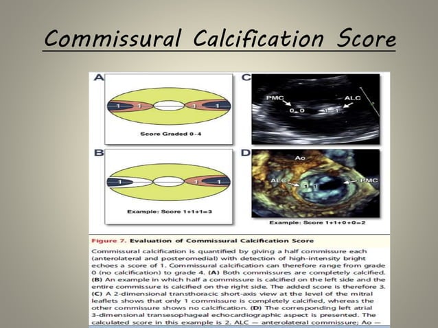 Mitral valve scoring before BMV | PPTX | Heart and Cardiovascular ...