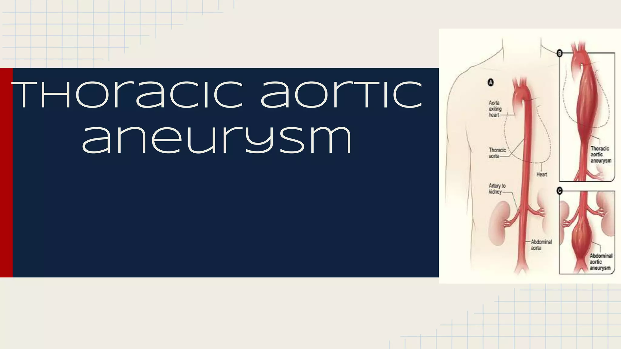 Thoracic aortic aneurysm | PPTX