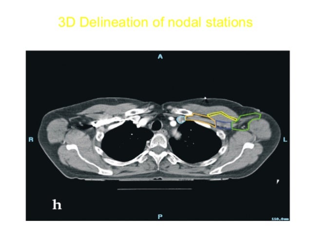 Marc Wigoda : Radiotherapy of the Axilla in Early Breast Cancer : Wh…