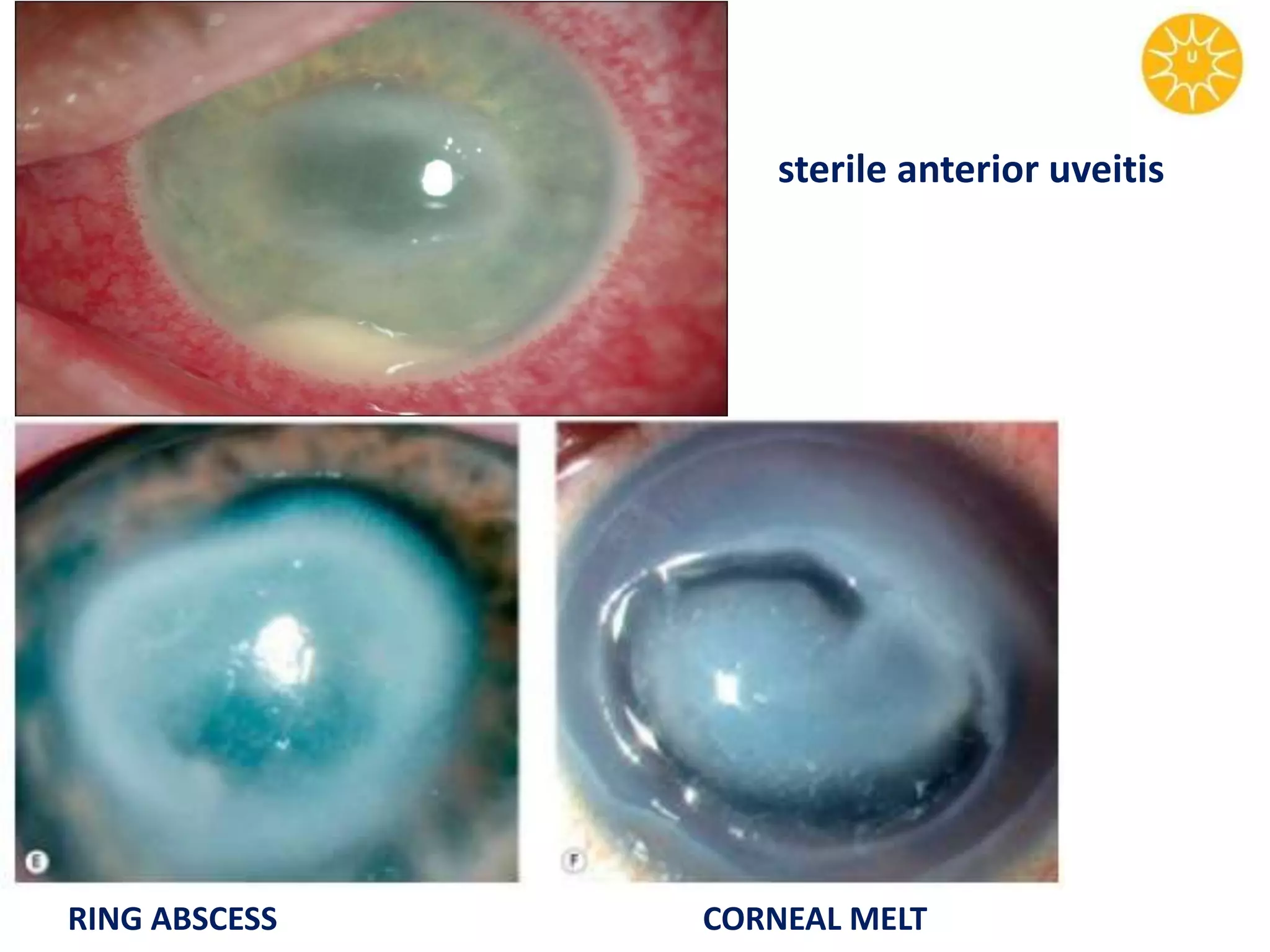 Acanthamoeba keratitis | PPTX