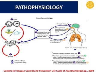 Acanthamoeba keratitis | PPTX