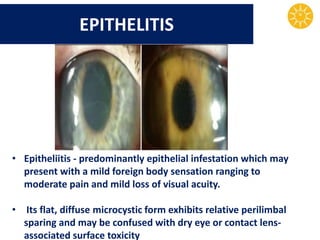 Perilimbic Sparing Conjunctivitis
