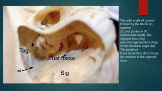 Mx of cholesteatoma dr rsl | PPTX