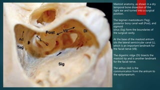 Mx of cholesteatoma dr rsl | PPTX