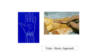 Mx of distal radius fractures | PPT