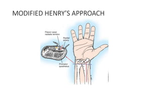 Mx of distal radius fractures | PPT
