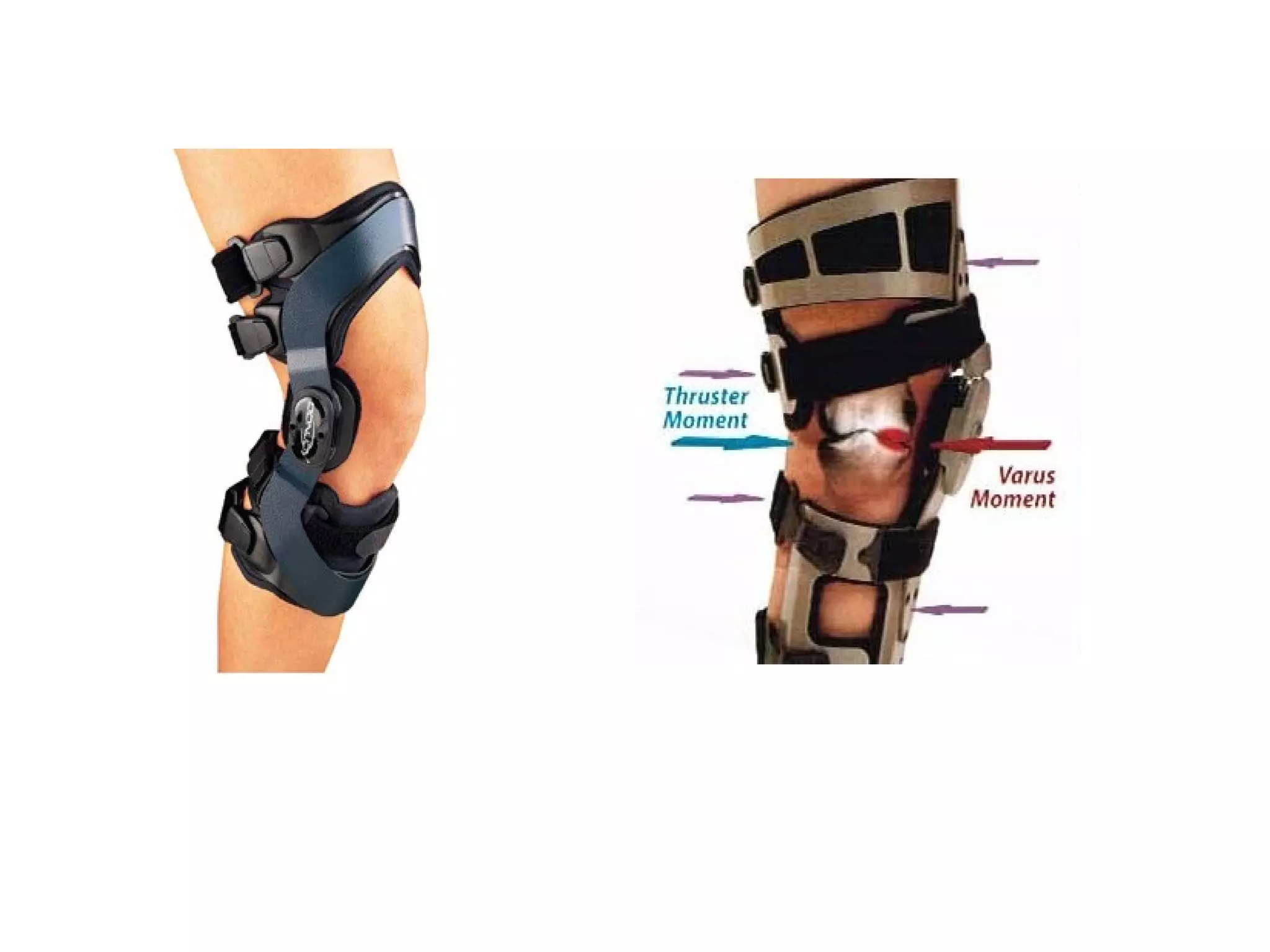 Management of Osteoarthritis | PPT