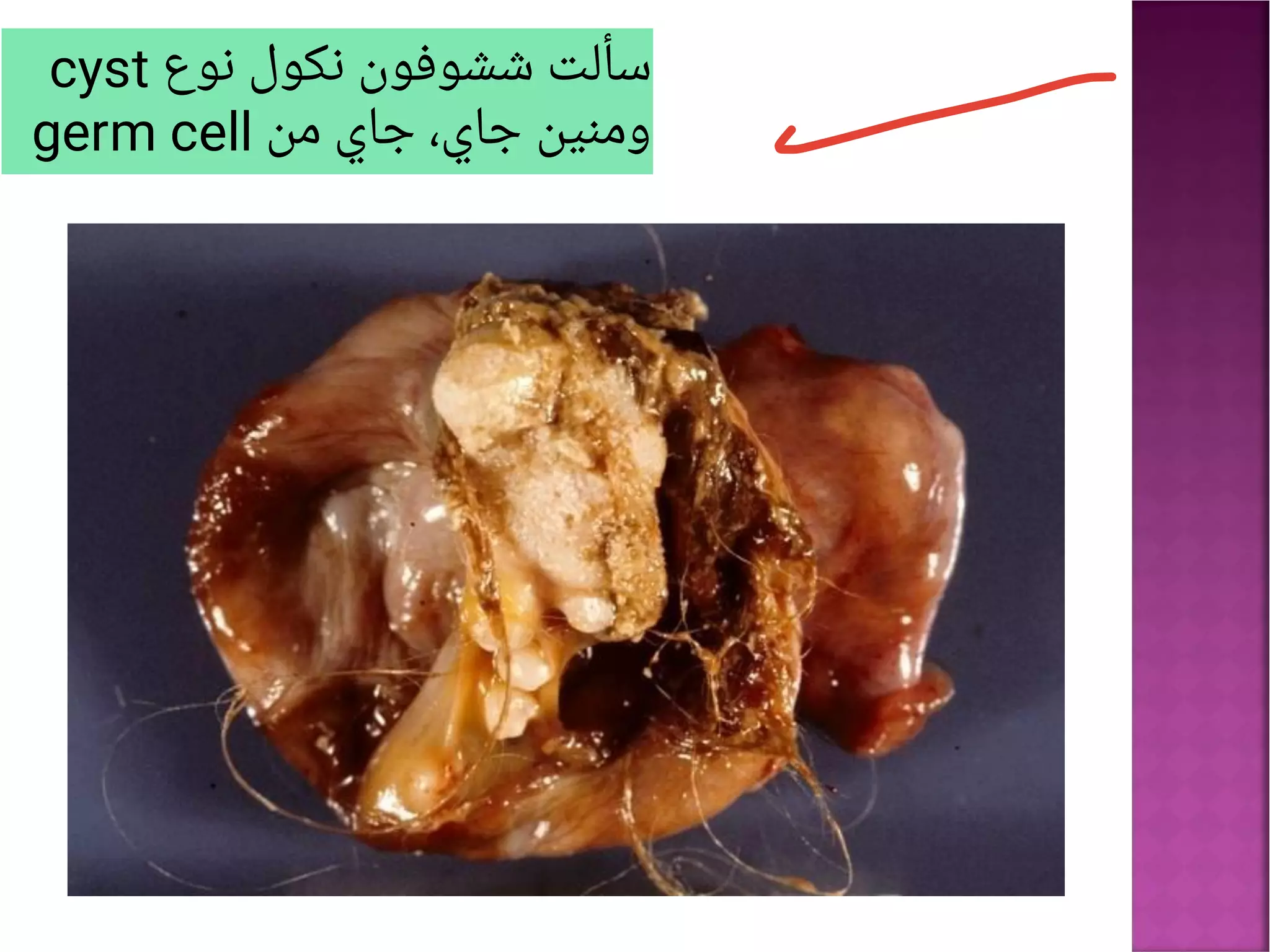 Management of ovarian cyst.pdf