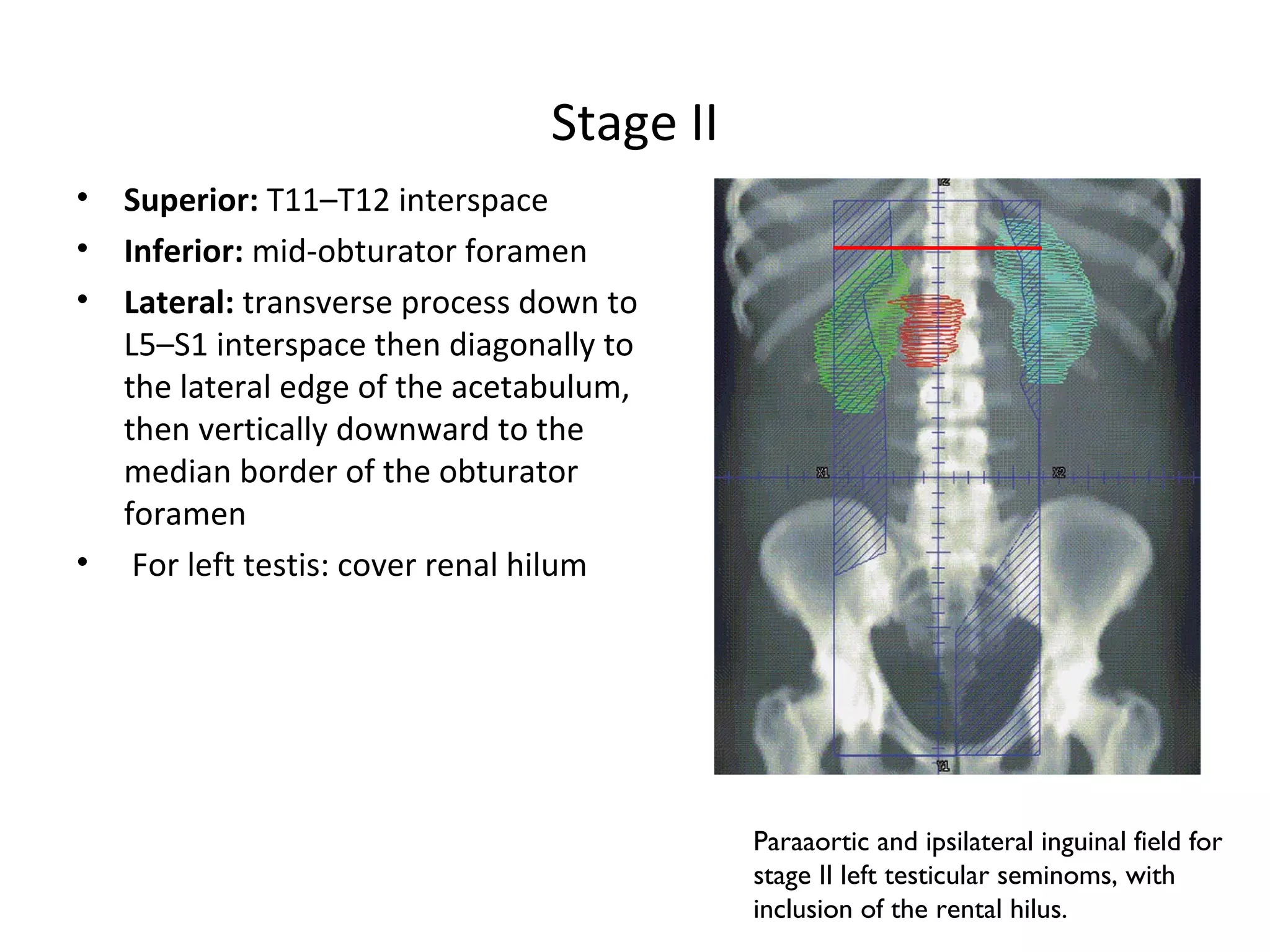 Management of testicular cancers | PPT